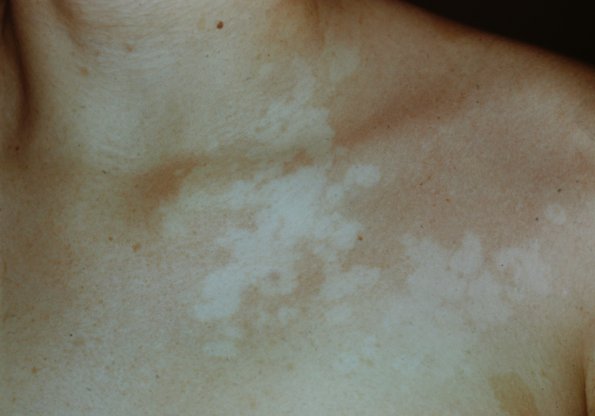 PICT0004 | Nevus Anemicus | Dr. Ken Hashimoto | Wayne State University SOM - Dermatology Image ...